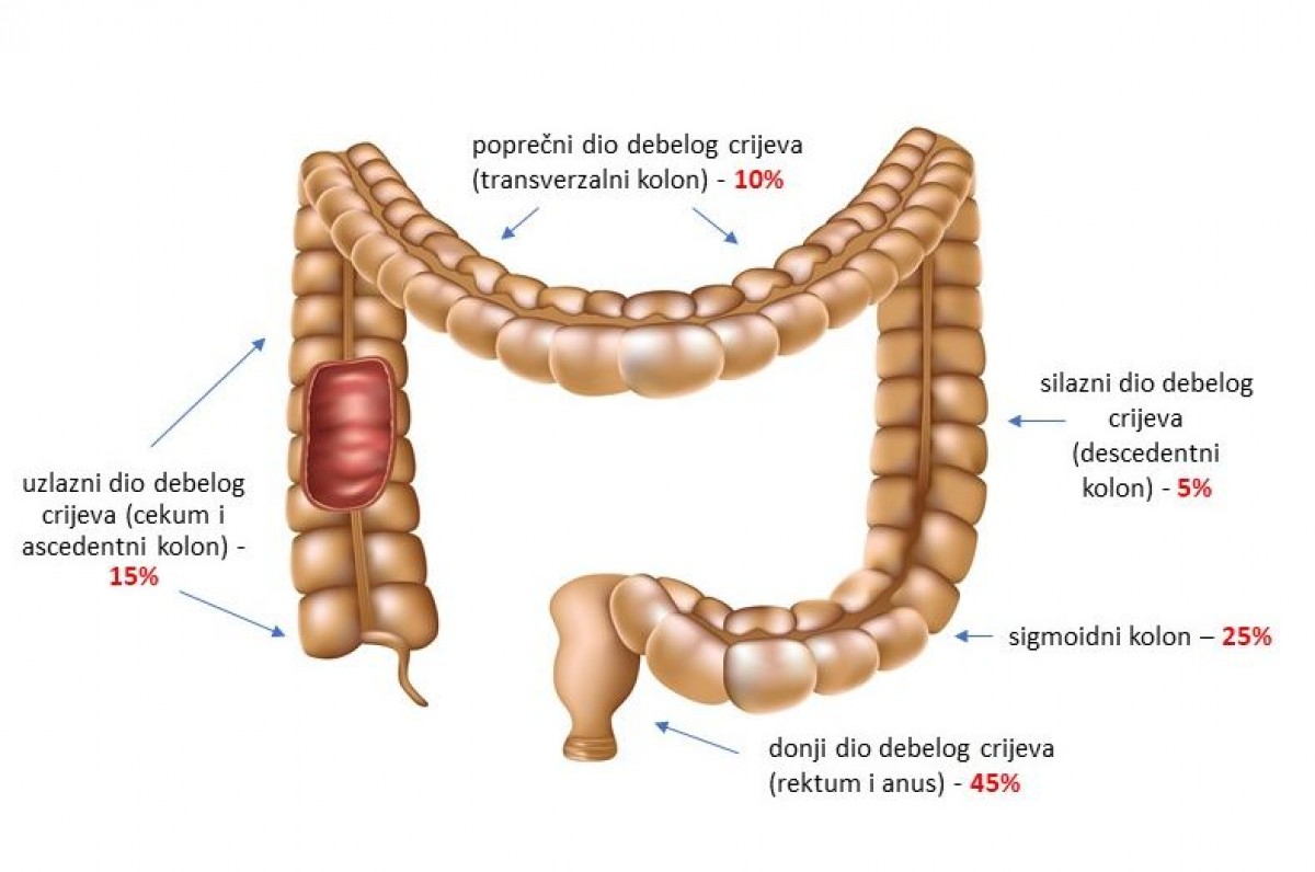 O raku debelog crijeva – Institut za gastroenterološke tumore